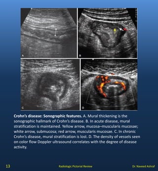 Crohns disease | PDF | Digestive Disorders | Diseases and Conditions