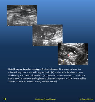 Crohns disease | PDF