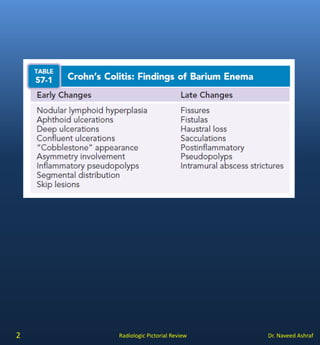 Crohns disease | PDF