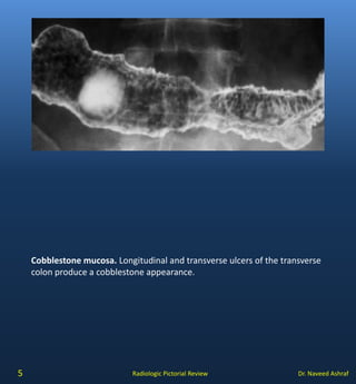 Crohns disease | PDF | Digestive Disorders | Diseases and Conditions