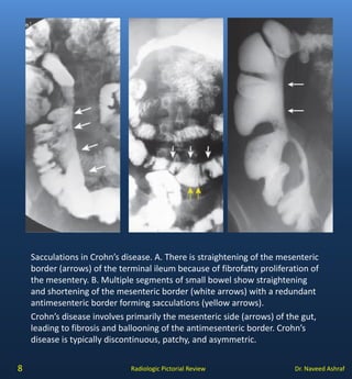 Crohns disease | PDF | Digestive Disorders | Diseases and Conditions