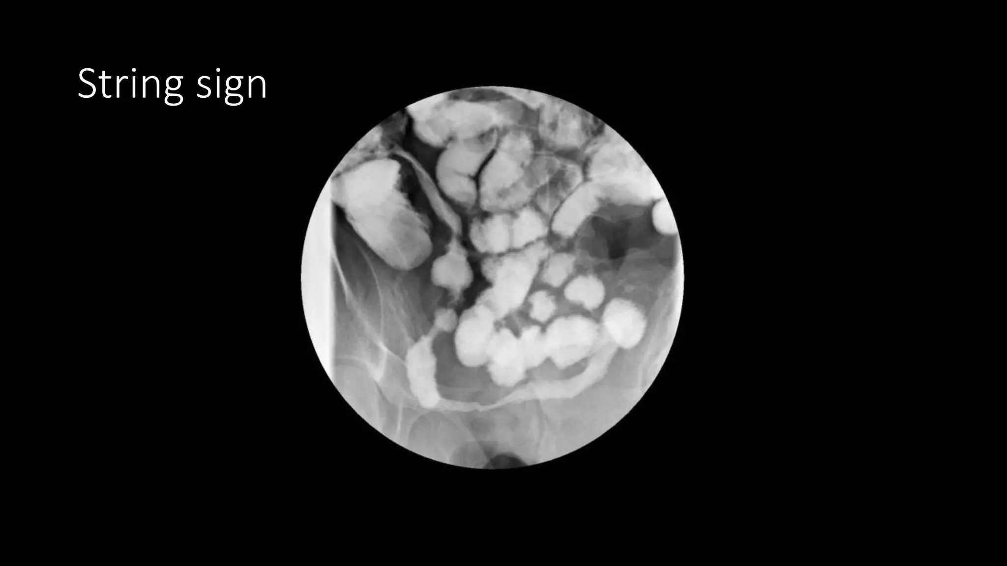 CROHN’S DISEASE.pptx