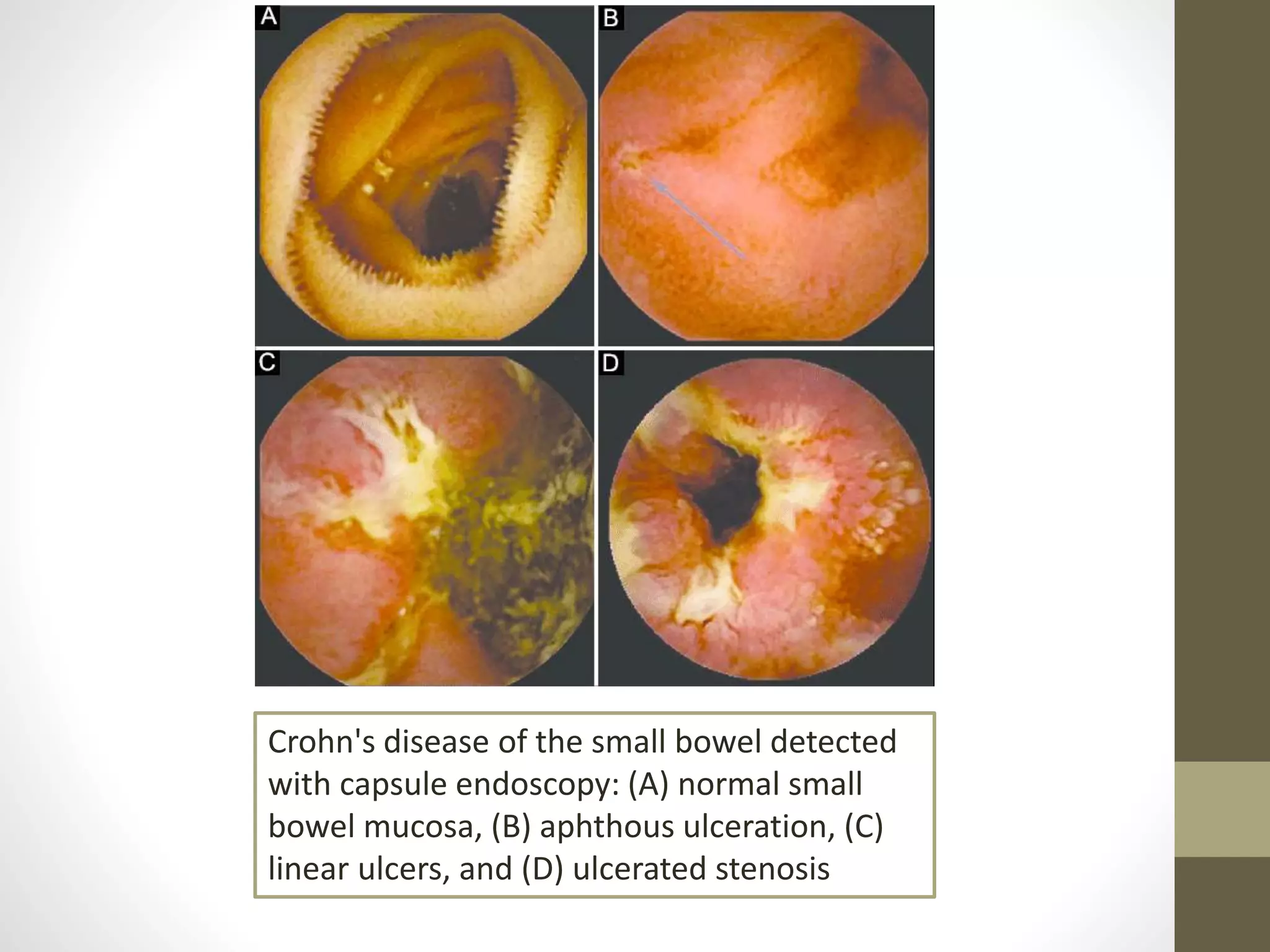 Crohn’s Disease | PPTX