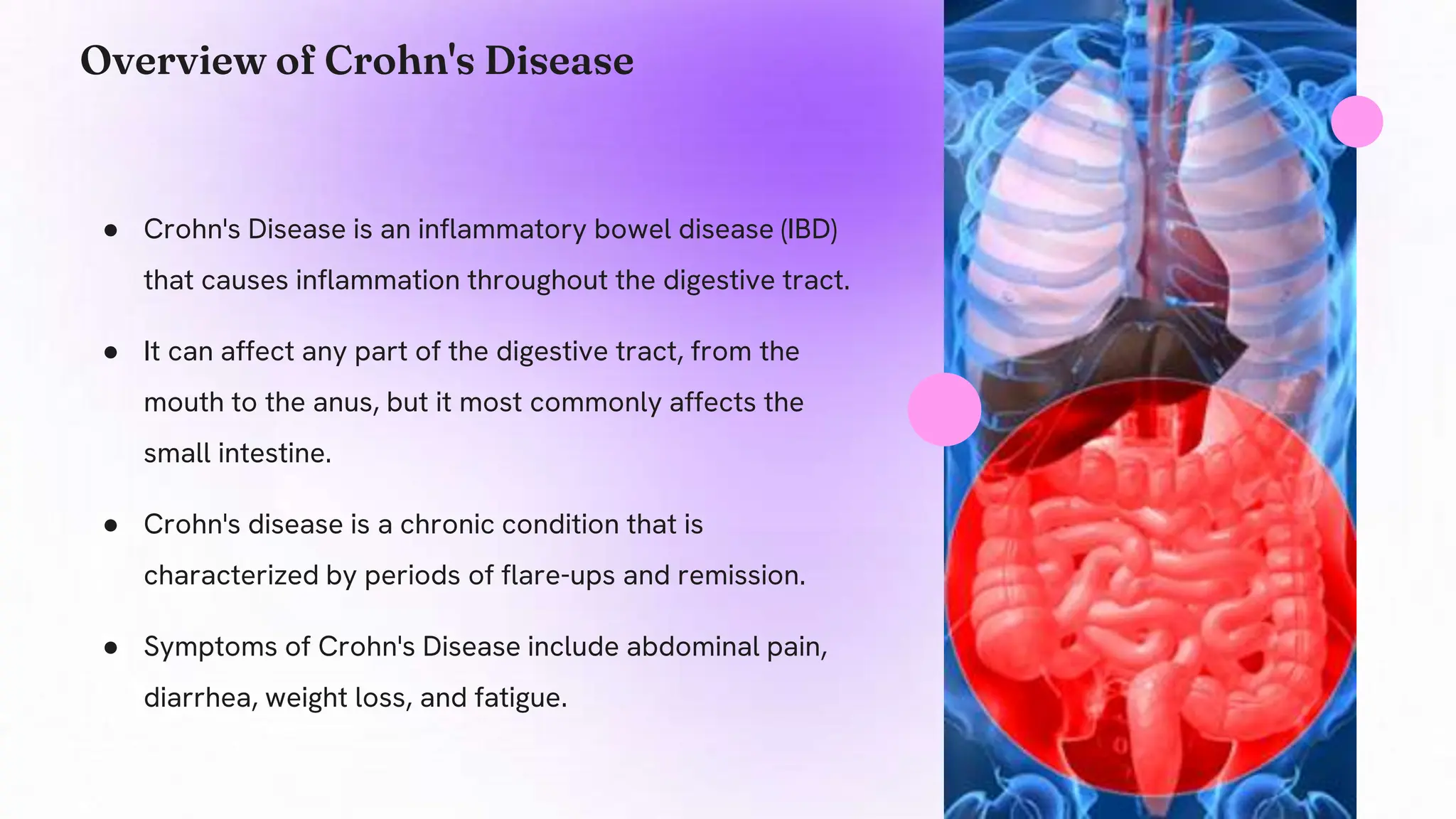 Crohn's Disease.pptx