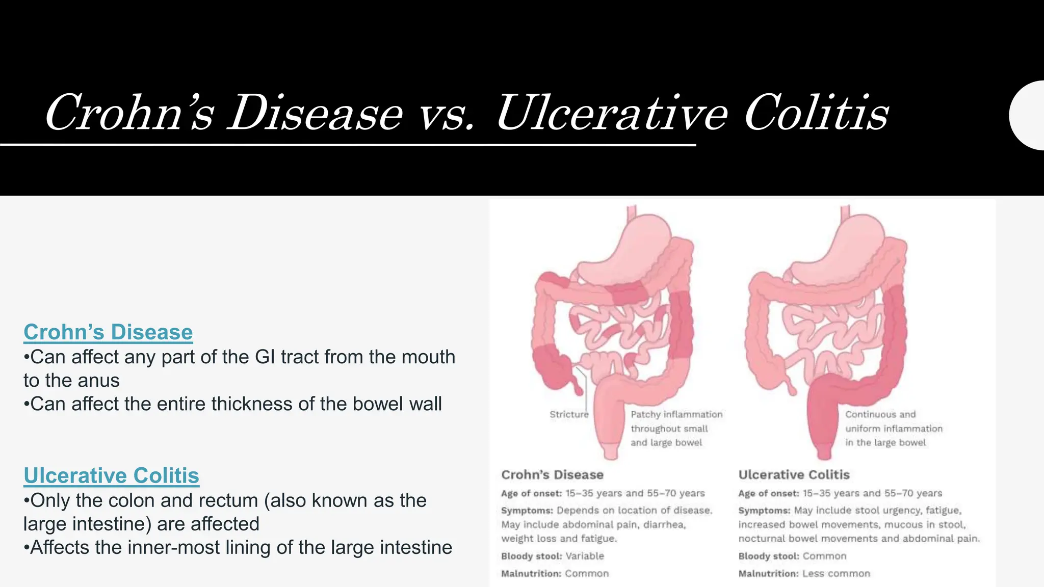 Crohn's Disease its causes with signs and symptoms | PPTX