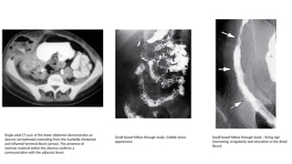 Crohn's disease diagnosis and management | PPTX