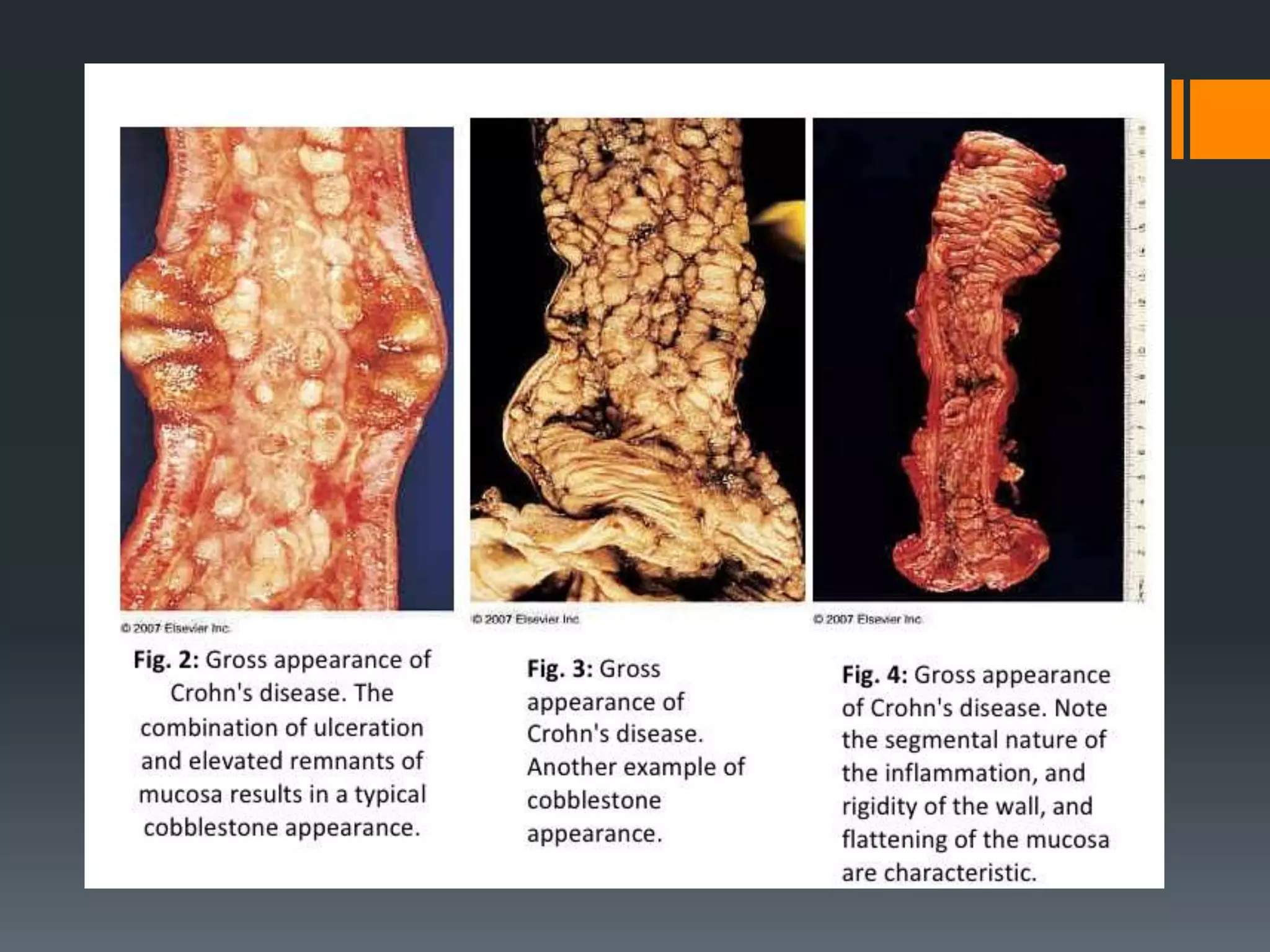 Crohn’s disease histopathology | PPTX