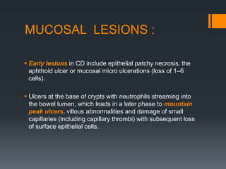 Crohn’s disease histopathology | PPTX