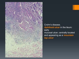 Crohn’s disease histopathology | PPTX