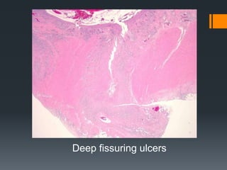 Crohn’s disease histopathology | PPTX