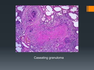 Crohn’s disease histopathology | PPTX