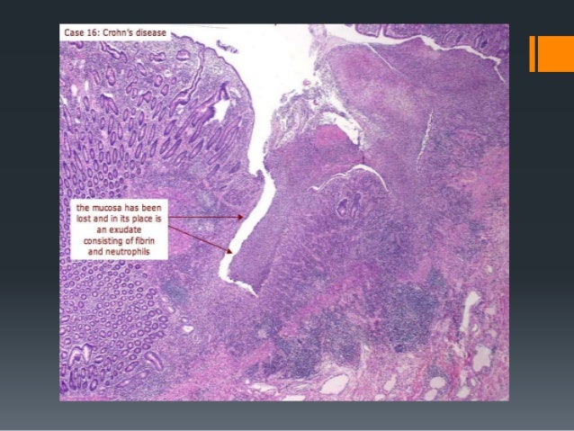 Crohn’s disease histopathology