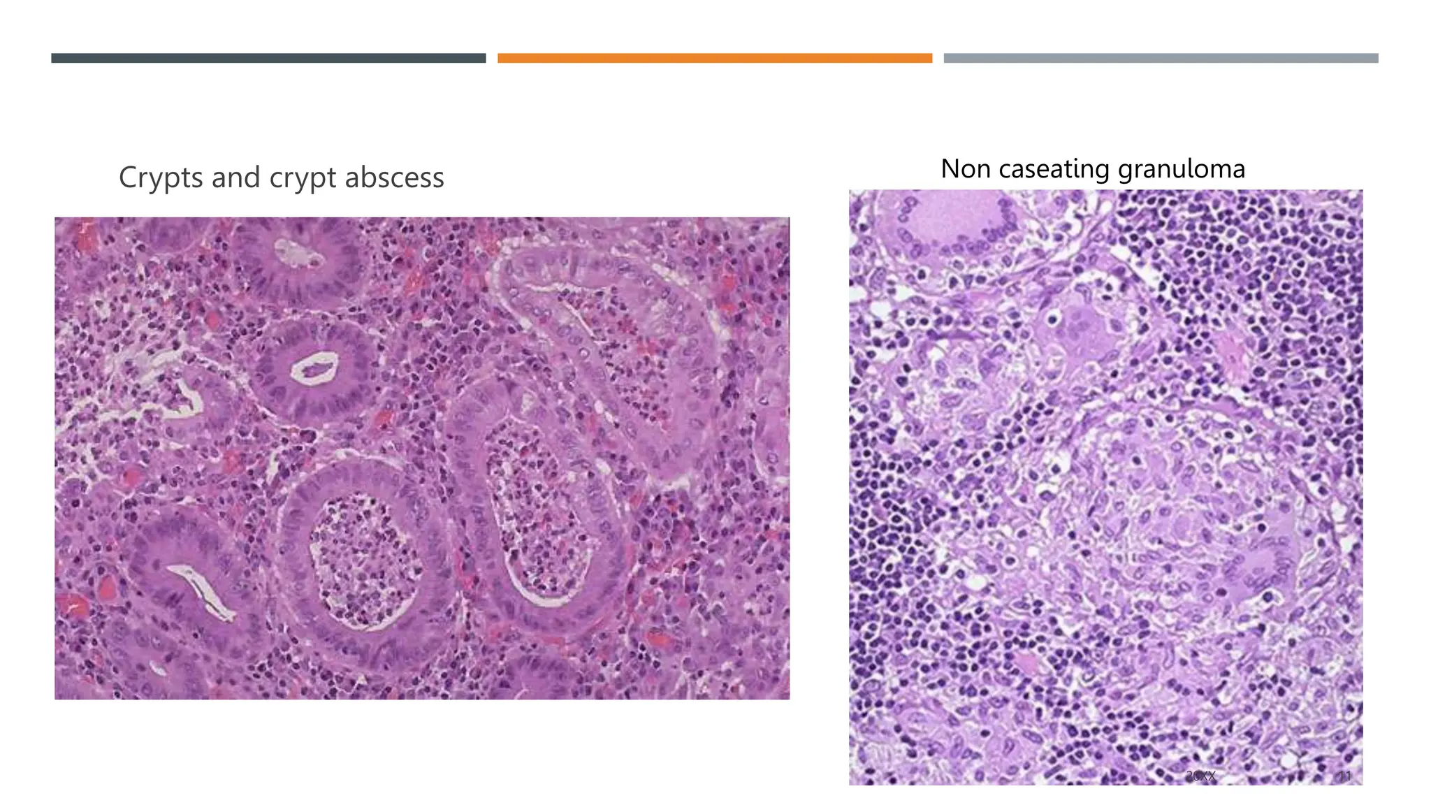 Crohn's Disease Pathology prsentation unfinshed.pptx