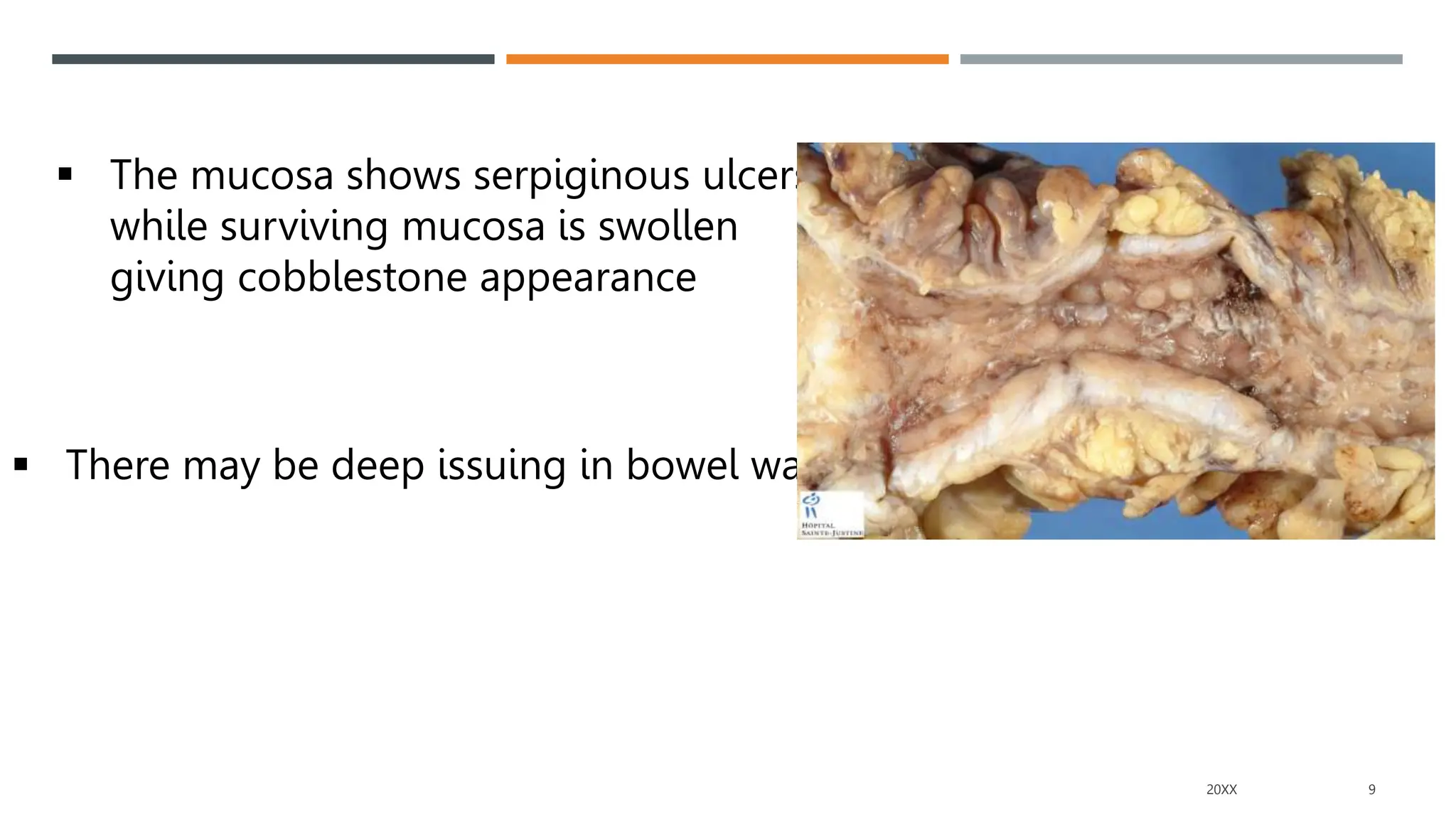 Crohn's Disease Pathology prsentation unfinshed.pptx