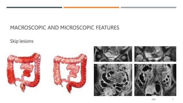Crohns Disease Pathology Prsentation Unfinshedpptx