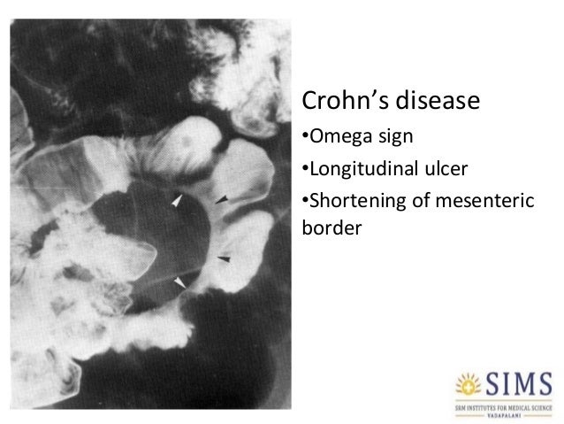 Crohn vs tb 2015 03 22 tnisgcon