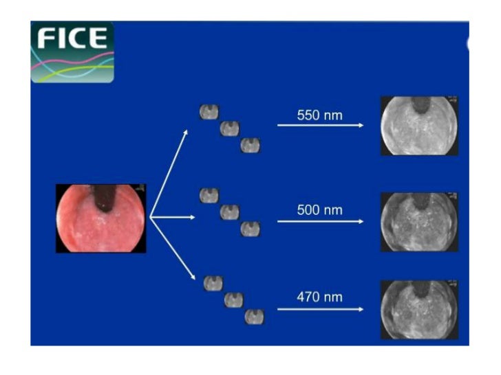 INNSZ. Cromoendoscopia