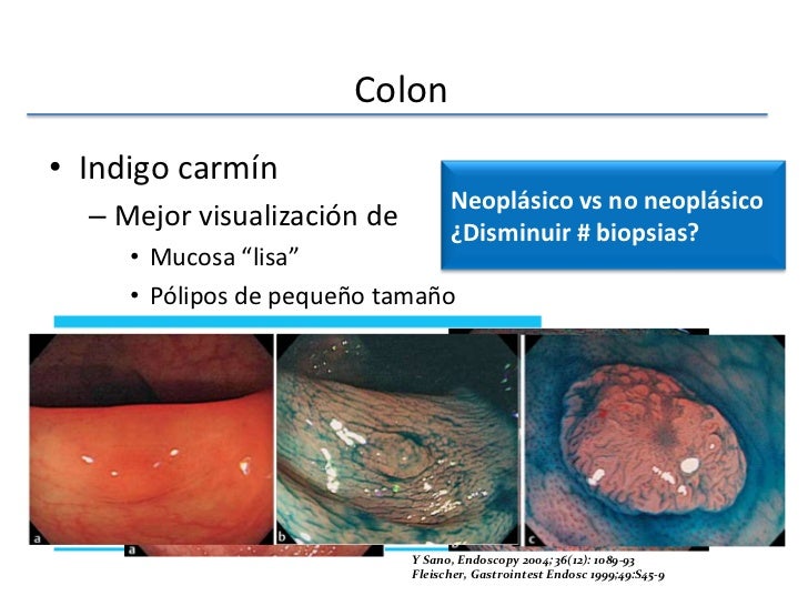 INNSZ. Cromoendoscopia