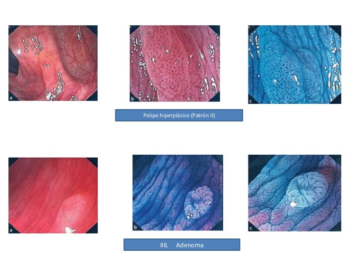 INNSZ. Cromoendoscopia