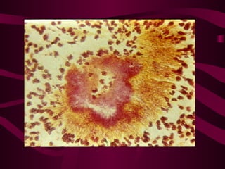 Cromomicosis | PPT