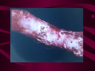Cromomicosis | PPT