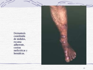 Cromomicosis | PPT