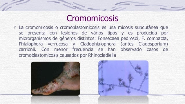 Cromomicosis (1)