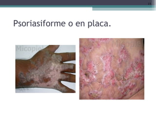 Cromomicosis | PPT