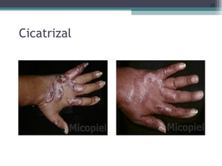 Cromomicosis | PPT
