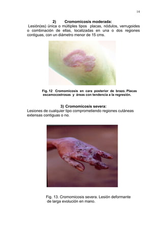 Cromomicosis en venezuela | PDF