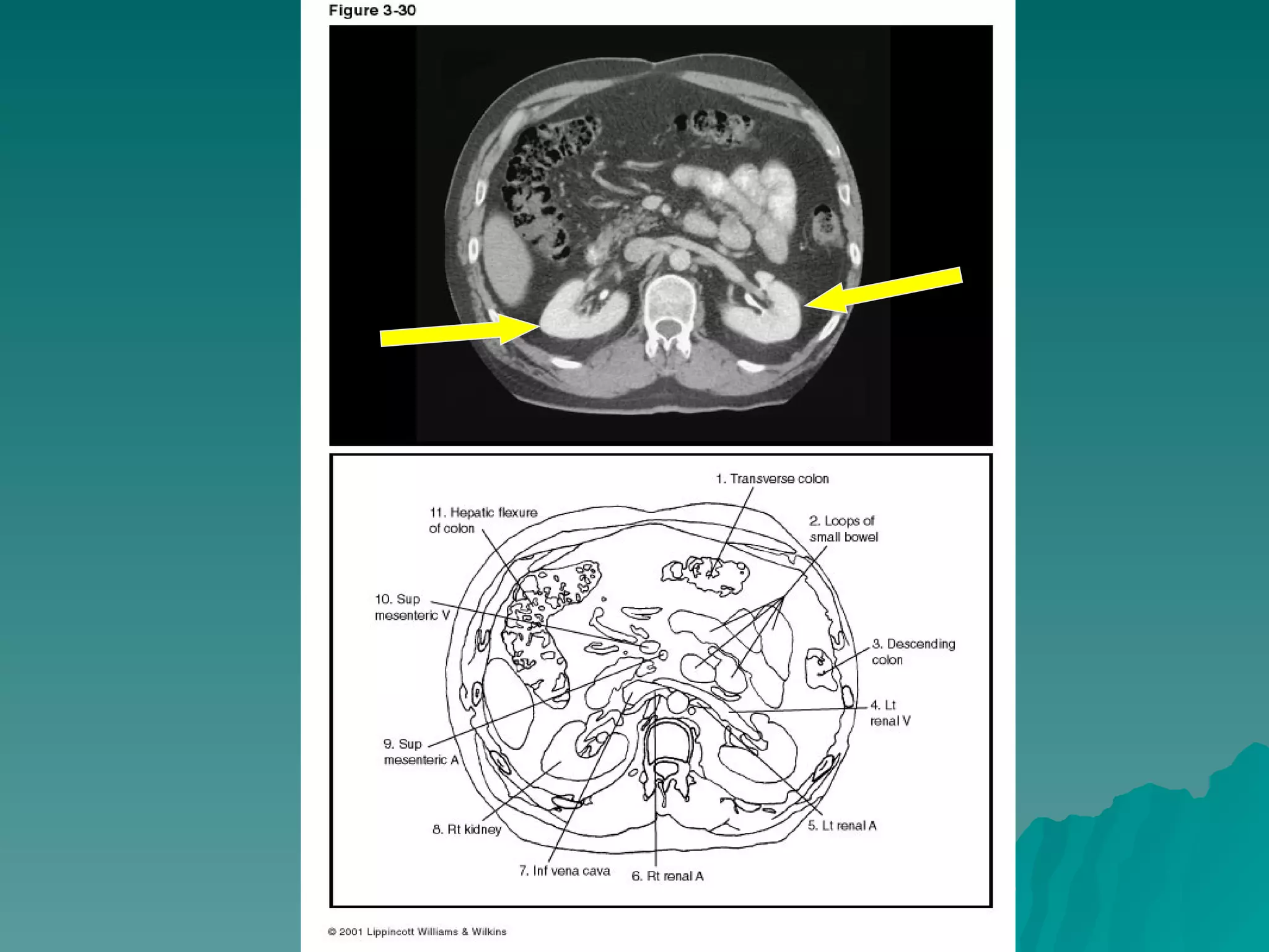 Cross Sectional Anatomy Of The Abdomen Annotated | PPT