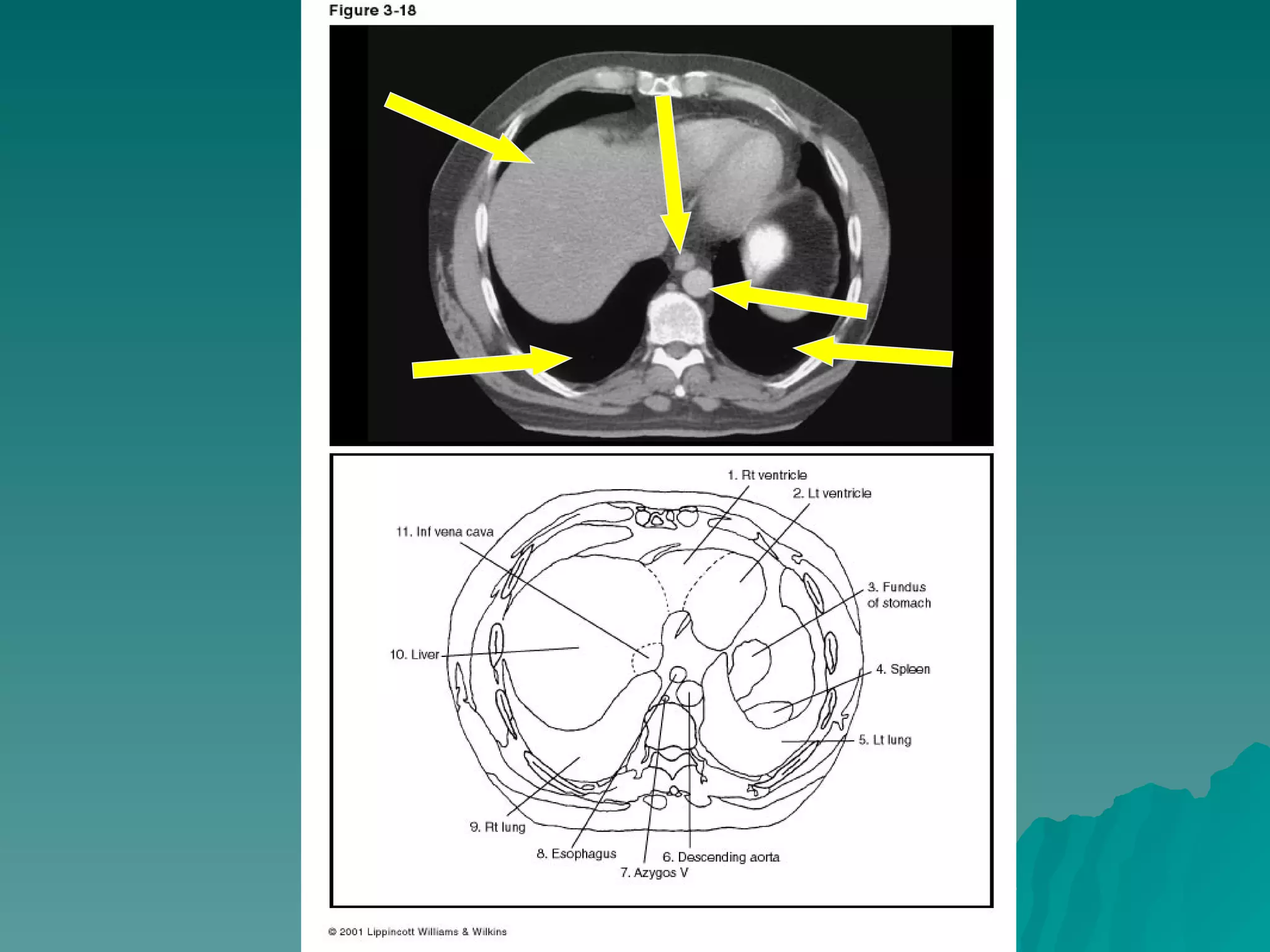 Cross Sectional Anatomy Of The Abdomen Annotated | PPT