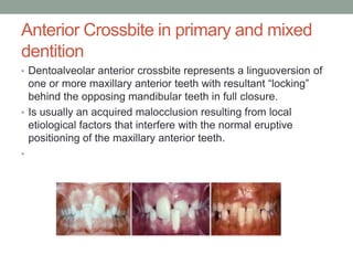 Crossbite | PPTX
