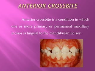 Malocclusion-Cross bite | PPT