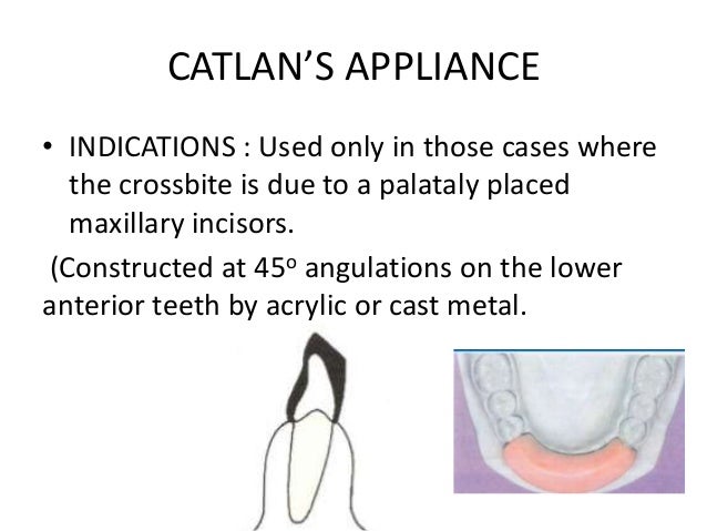 Crossbite