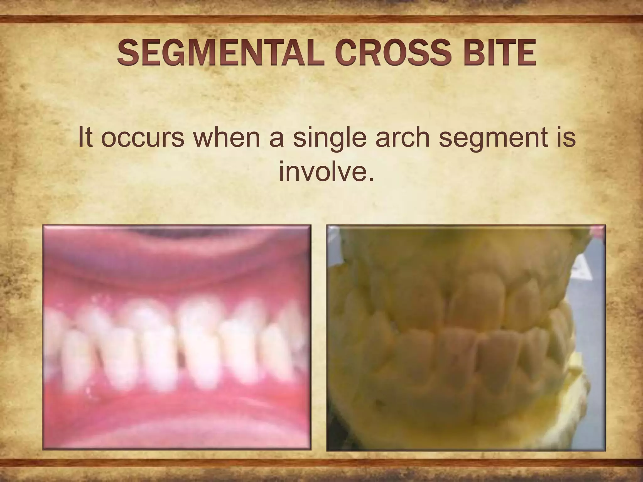 Crossbite in orthodontics,its types and management with two cases | PPTX