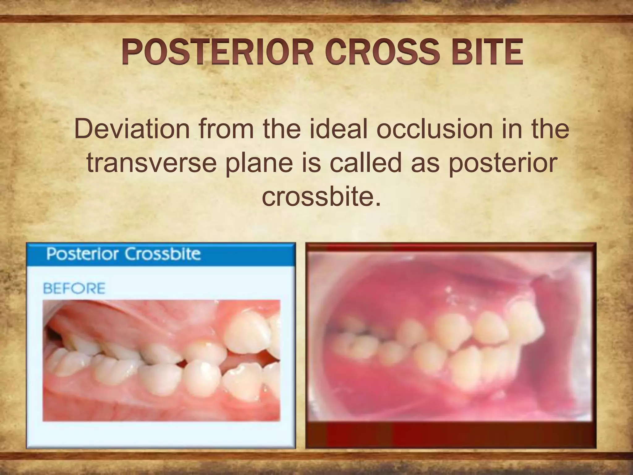 Crossbite in orthodontics,its types and management with two cases | PPTX