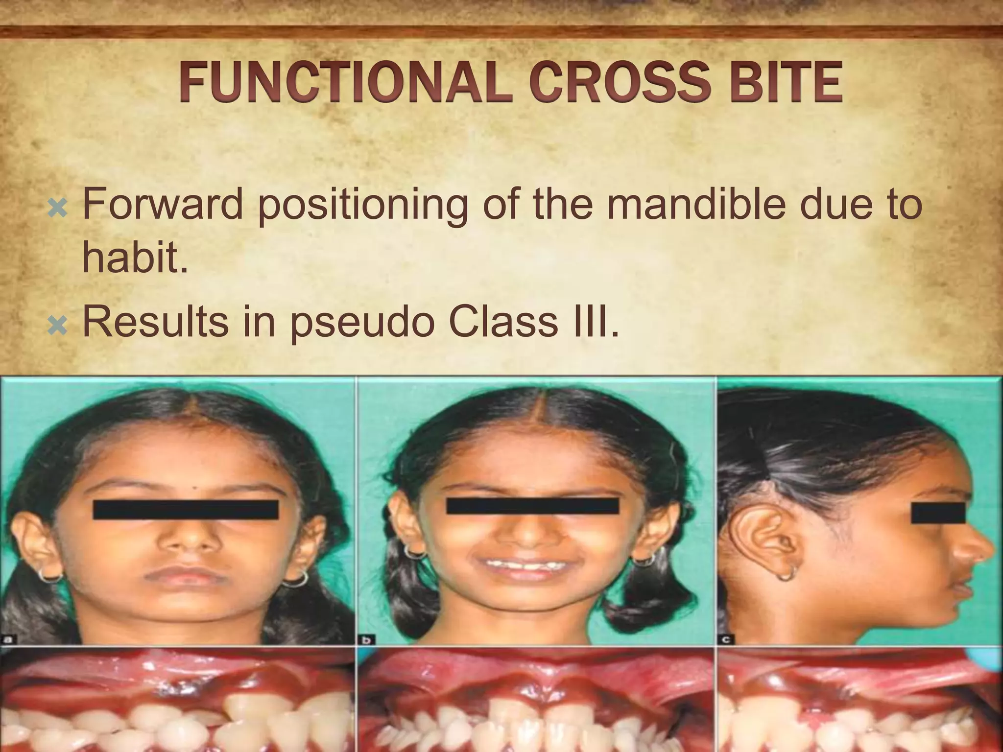 Crossbite in orthodontics,its types and management with two cases | PPTX