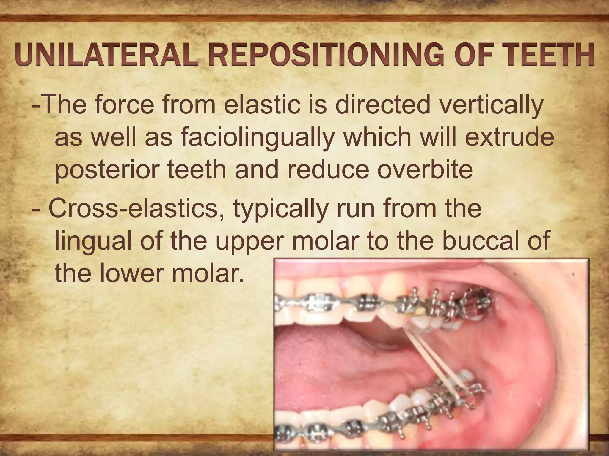 Crossbite in orthodontics,its types and management with two cases | PPTX