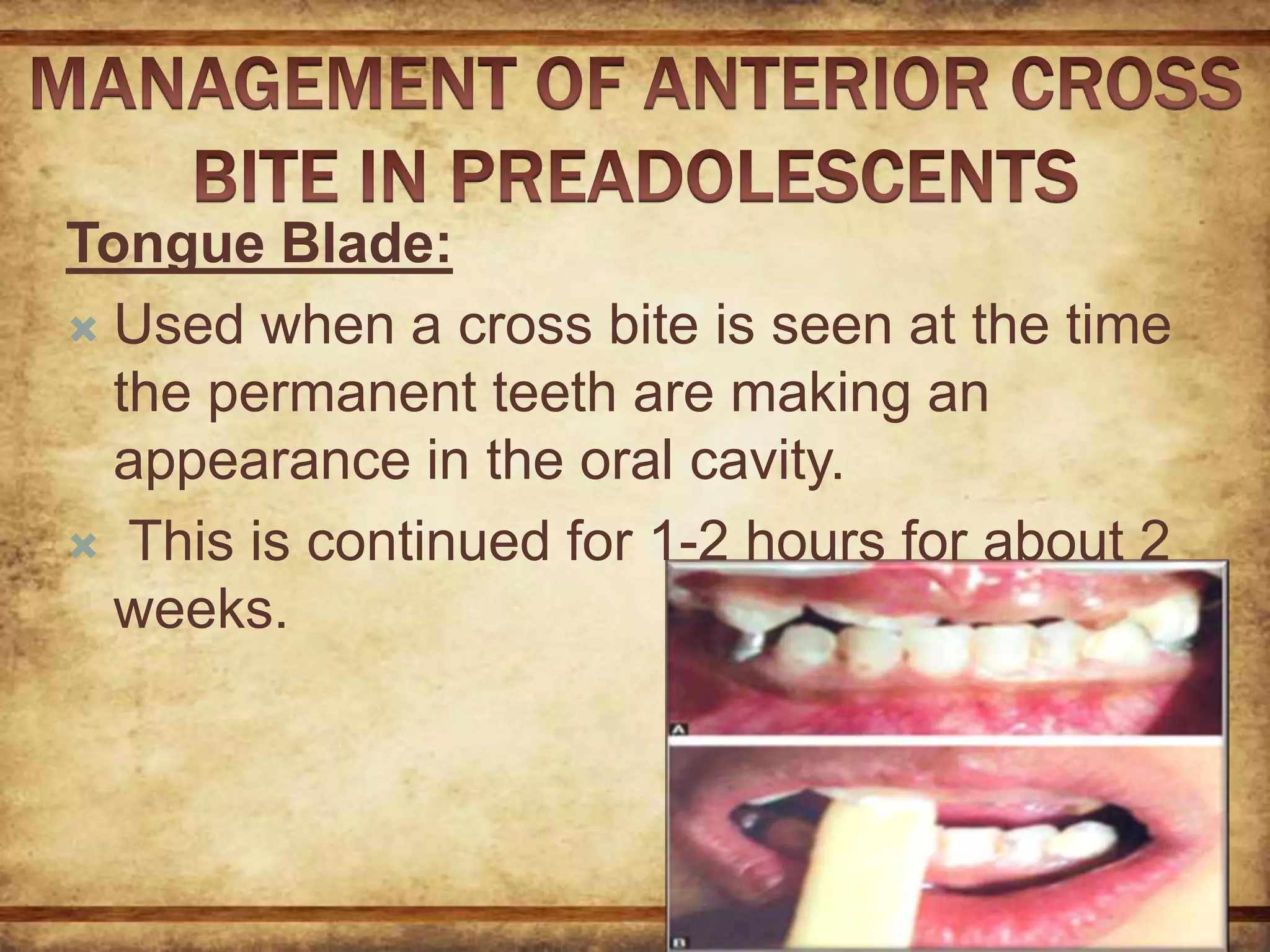 Crossbite in orthodontics,its types and management with two cases | PPTX