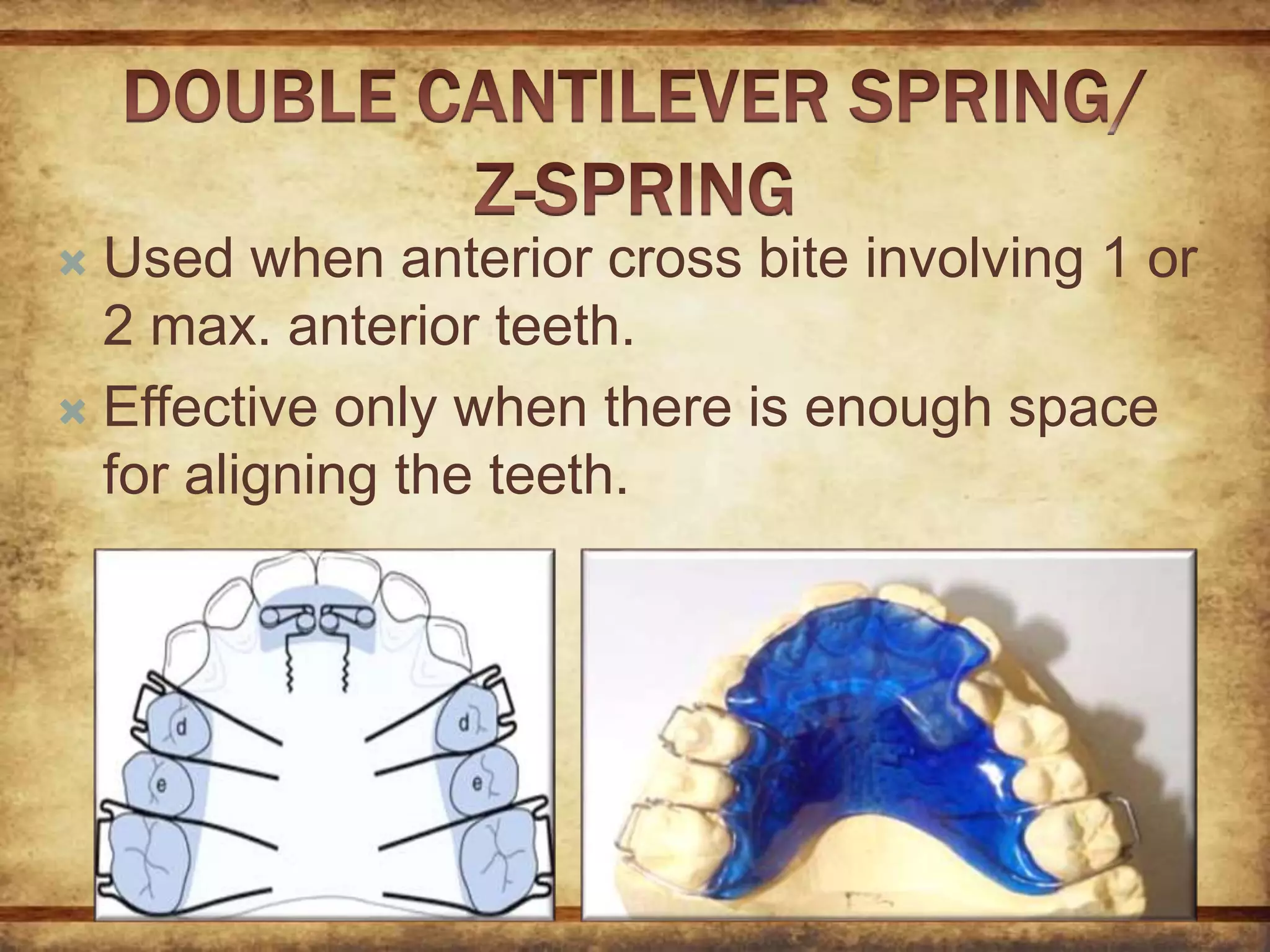 Crossbite in orthodontics,its types and management with two cases | PPTX