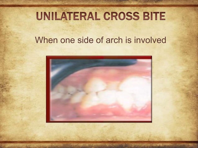 Crossbite in orthodontics,its types and management with two cases ...
