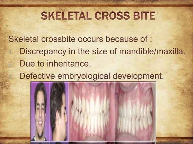 Crossbite in orthodontics,its types and management with two cases | PPT