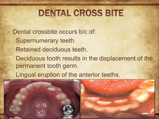 Crossbite in orthodontics,its types and management with two cases ...