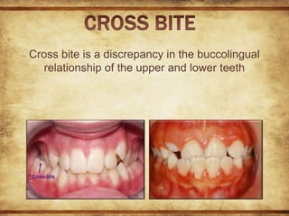 Crossbite in orthodontics,its types and management with two cases | PPT
