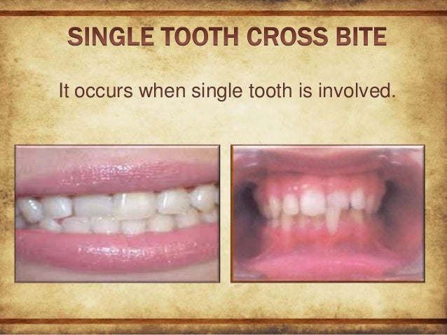 Crossbite in orthodontics,its types and management with two cases