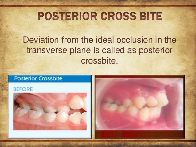 Crossbite in orthodontics,its types and management with two cases
