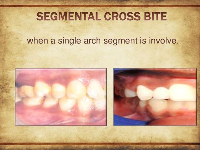 Crossbite in orthodontics,its types and management with two cases