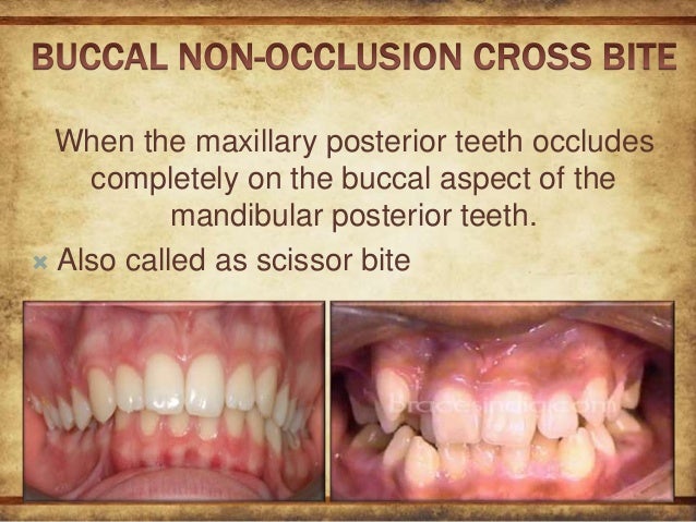 Crossbite in orthodontics,its types and management with two cases