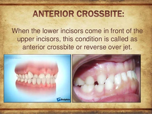 Crossbite in orthodontics,its types and management with two cases